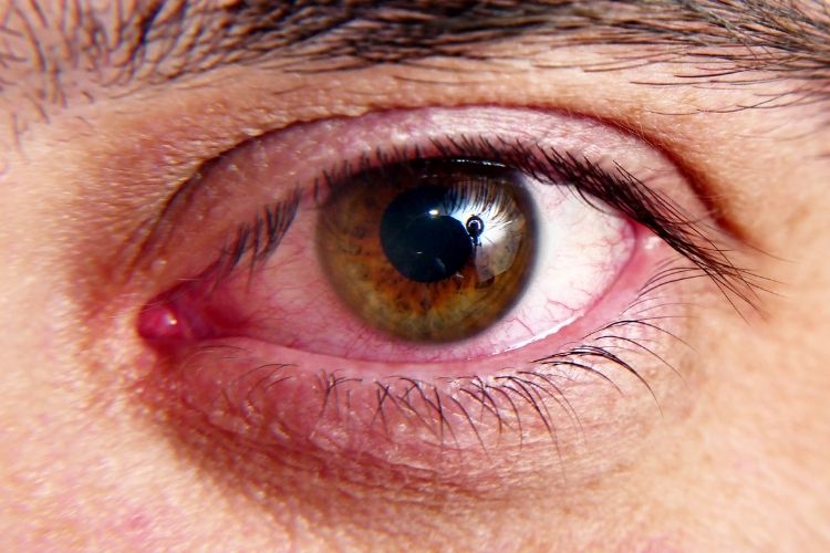 28 Home Proven Remedies for Red Eyes | HealthyLine